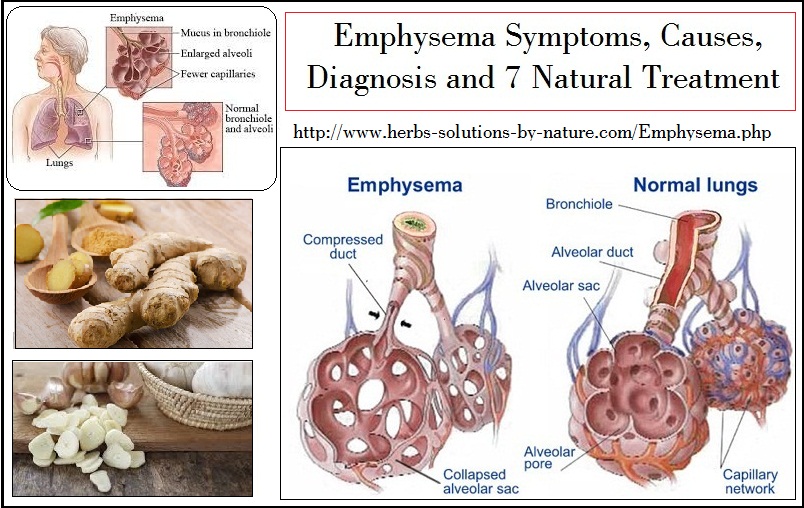 Exclusive Information about Emphysema Symptoms, Causes Diagnosis and ...