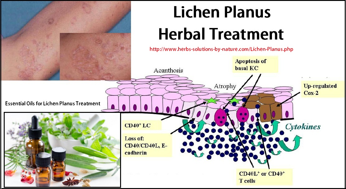 Lichen Planus Causes, Symptoms, Diagnosis and Herbal Treatment - Herbs ...