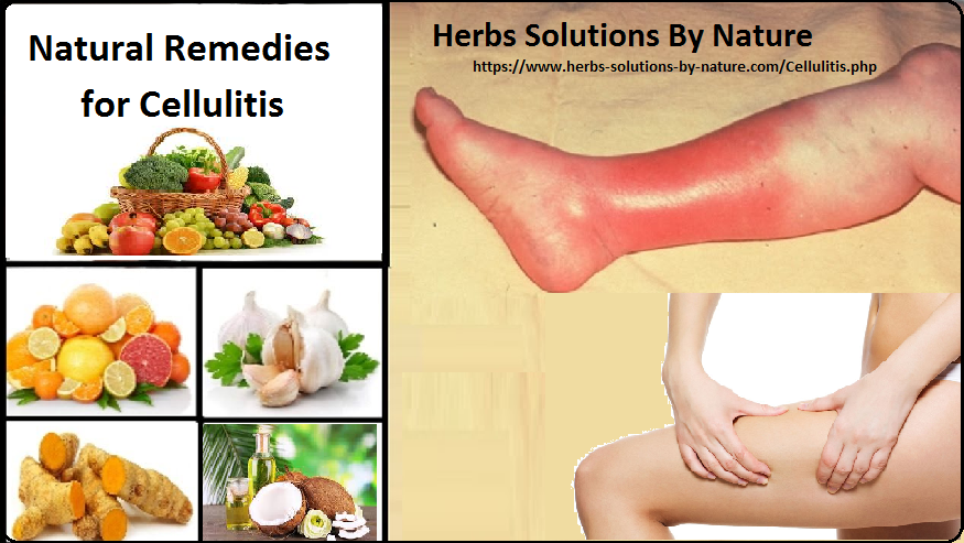 Natural Remedies for Cellulitis and Some Recommended Food - Herbs ...