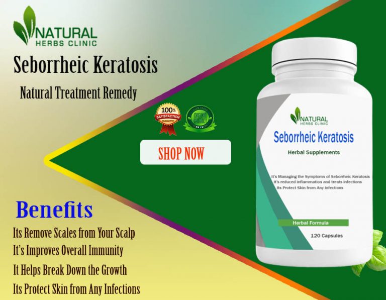 Home Remedies For Seborrheic Keratosis Seborrheic Ker - vrogue.co Home Remedies For Seborrheic Keratosis Seborrheic Ker - vrogue.co