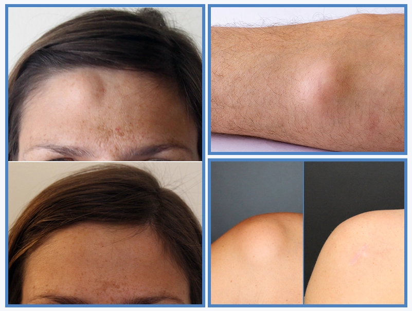 How to Safely Remove a Lipoma Yourself: A Step-by-Step Guide - Herbs ...