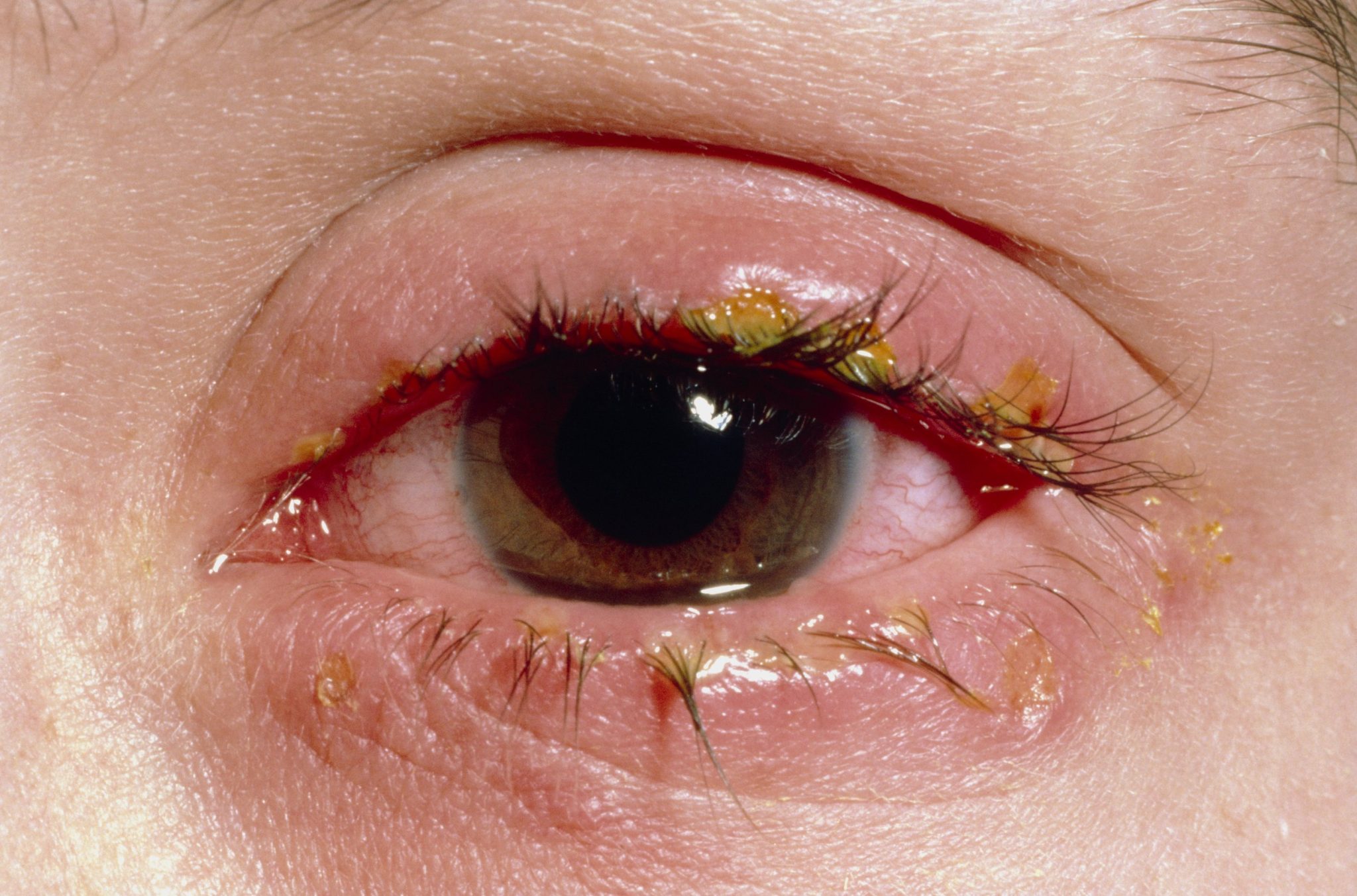 Blepharitis Treatment Without Harsh Chemicals: Discover These Natural ...